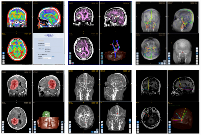 When top-notch surgical operations are equipped with "brain GPS"-News ...